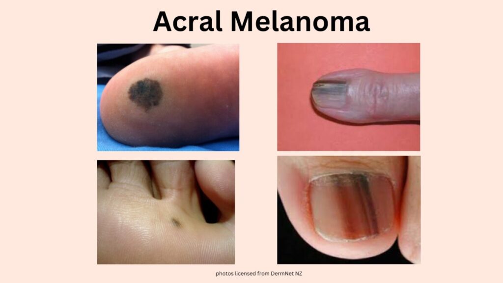 Imágenes de melanoma: AIM en la Skin Cancer Foundation