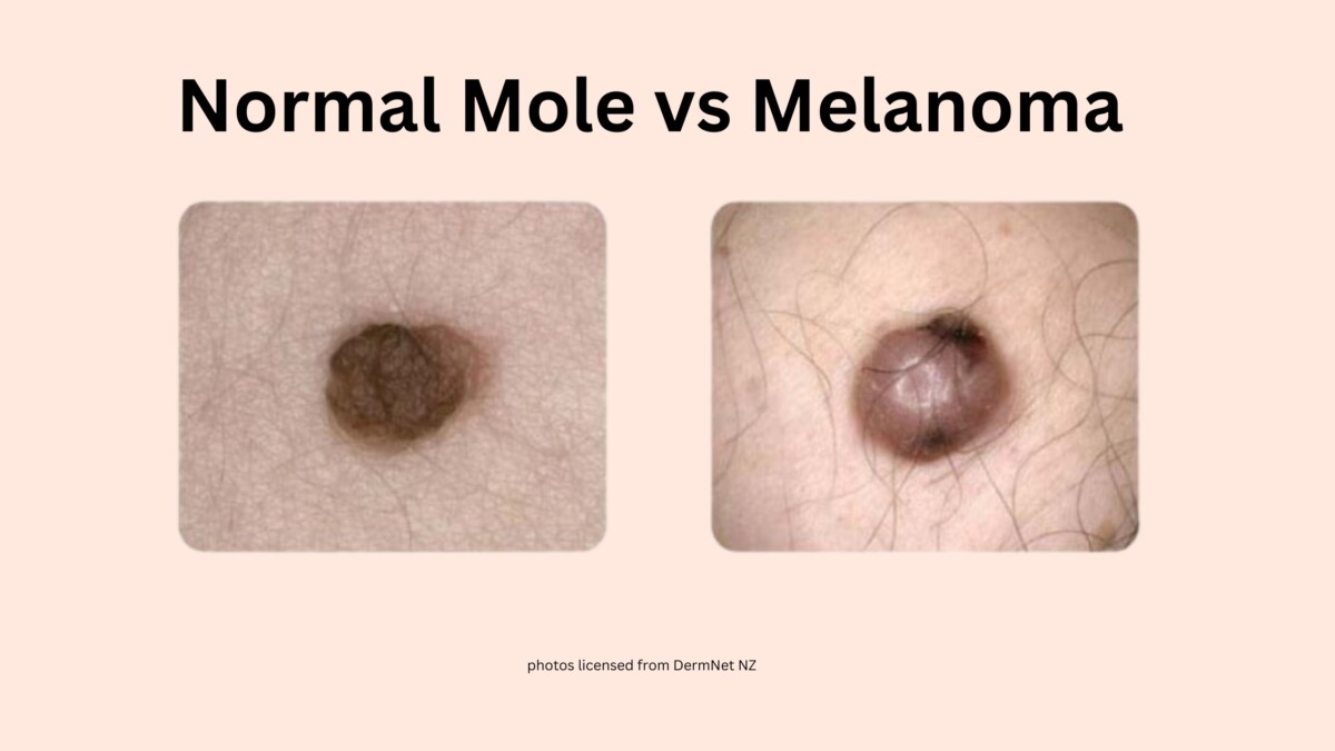 Imágenes de melanoma: AIM en la Skin Cancer Foundation