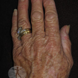 Immagini del cancro della pelle - AIM presso la Skin Cancer Foundation