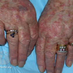 Skin Cancer Images - AIM at Skin Cancer Foundation