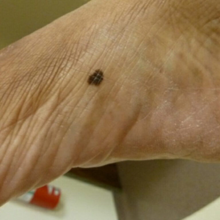 Images of Skin Cancer in People with Skin of Color - AIM at Skin Cancer ...