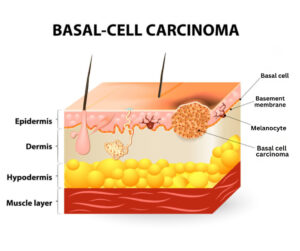 Sobre el carcinoma de células basales o basilioma - AIM at Skin Cancer ...