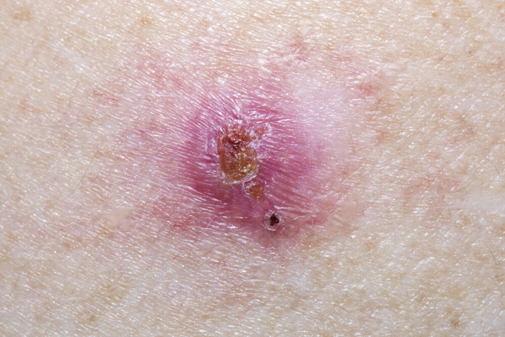 Basal Cell Carcinoma Images- Canada - AIM at Skin Cancer Foundation