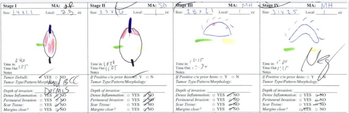 A Mohs Surgeon Explains the Procedure - AIM at Skin Cancer Foundation