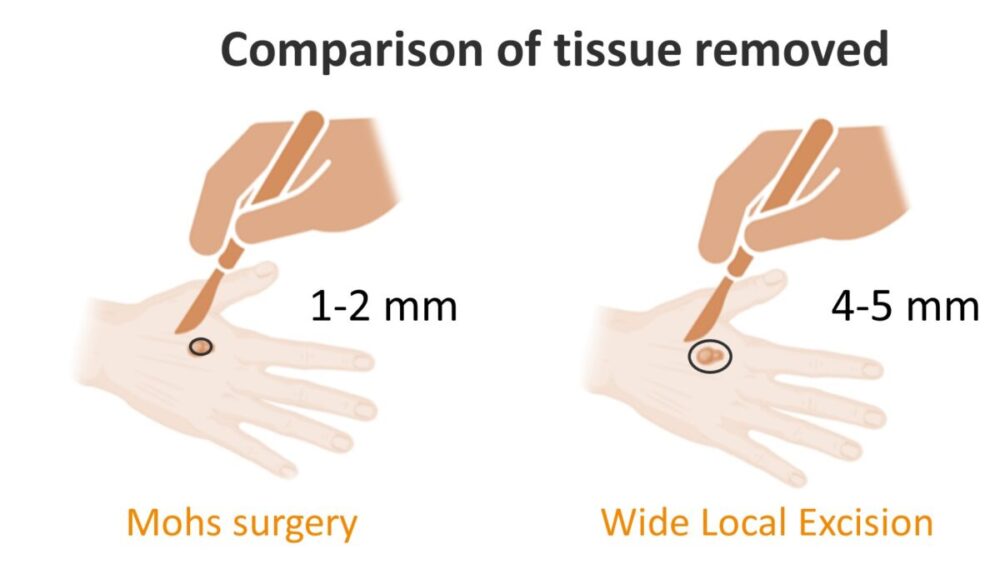 Wide Local Excision vs. Mohs Surgery: A Dermatologist Explains - AIM at ...