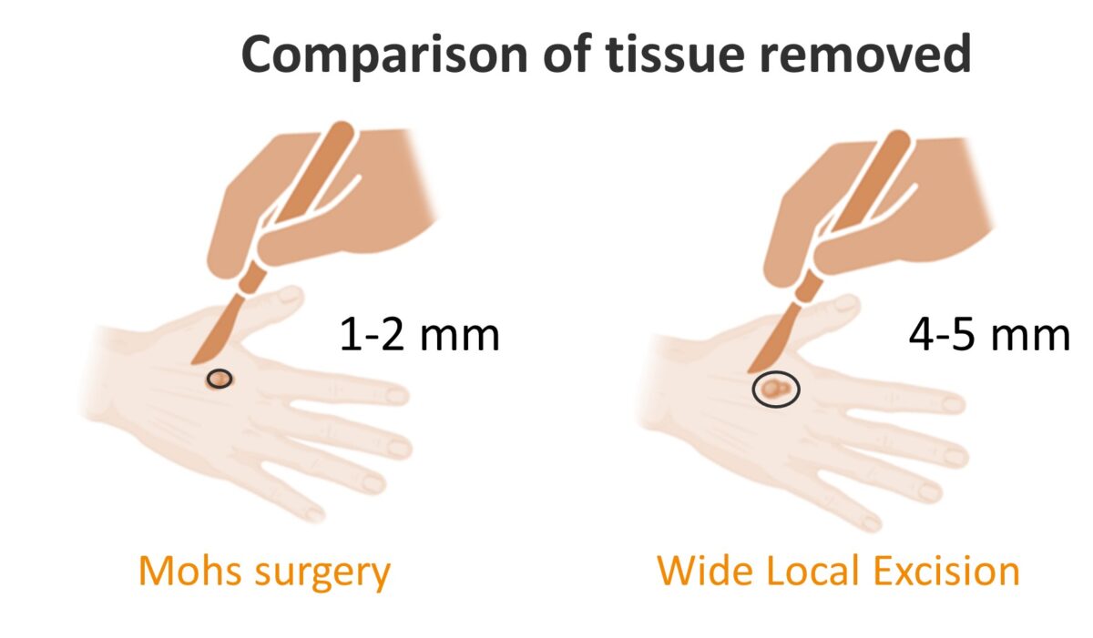 Wide Local Excision vs. Mohs Surgery: A Dermatologist Explains - AIM at ...