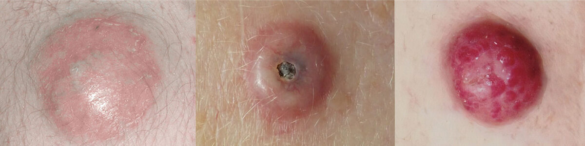 Understanding Merkel Cell Carcinoma: What Patients and Families Should ...